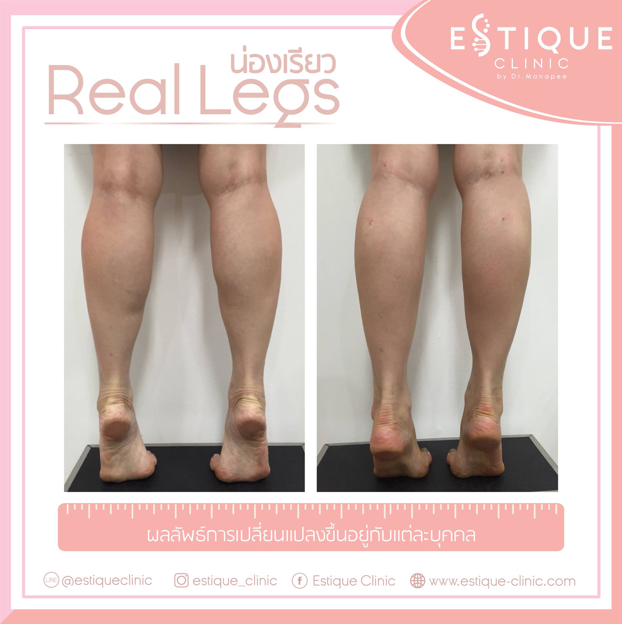 Real legs – คลินิกศัลยกรรมความงาม