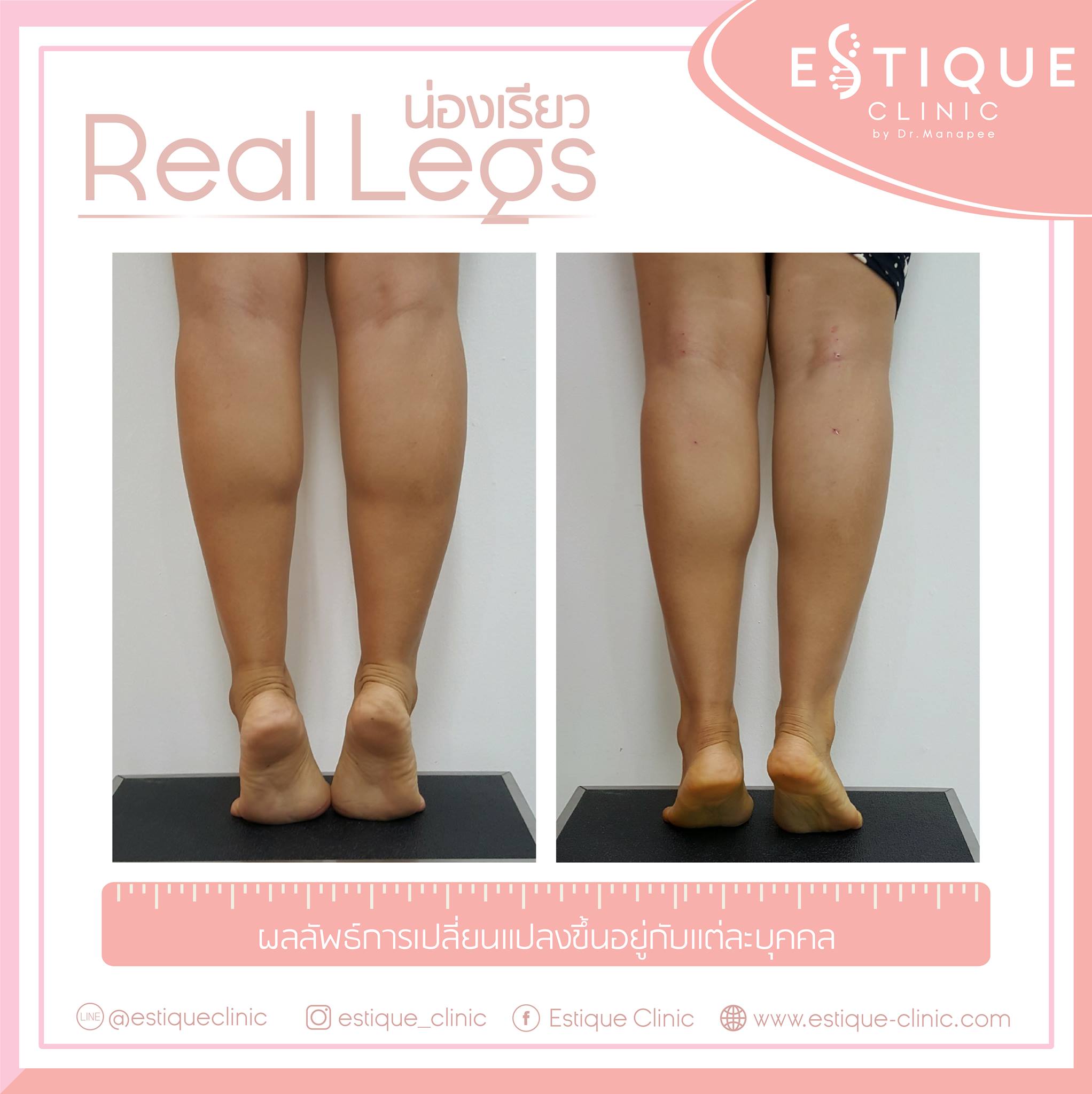 Real legs – คลินิกศัลยกรรมความงาม