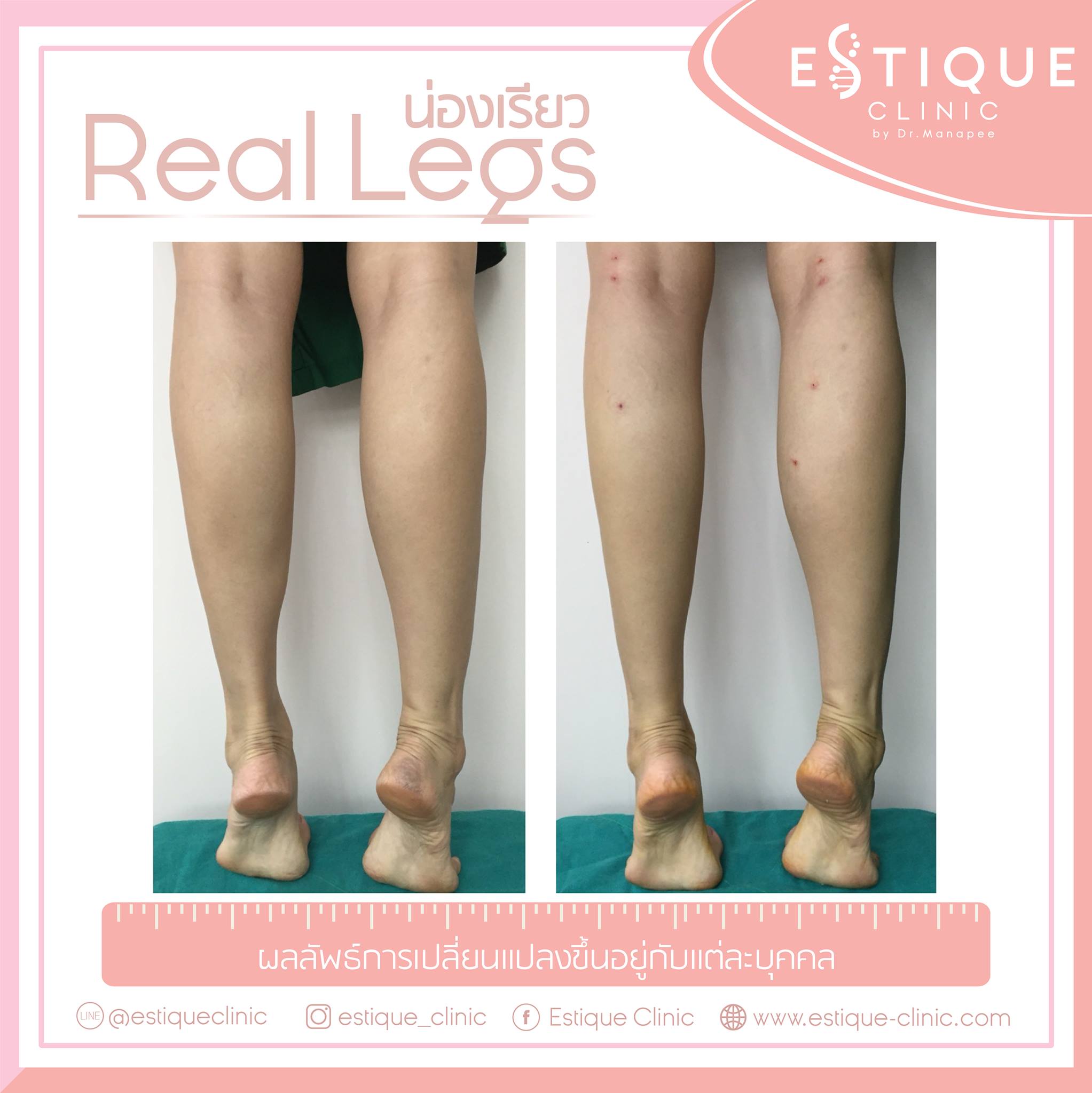 Real legs – คลินิกศัลยกรรมความงาม