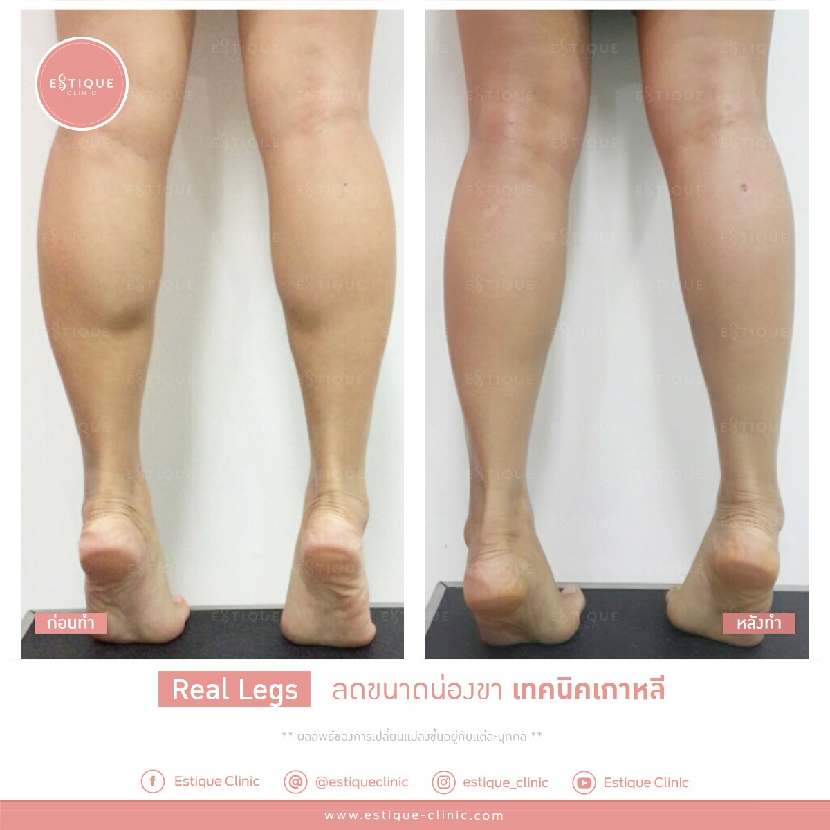 คลินิกลดน่อง จี้น่องเรียว ลดน่องถาวร ด้วย Real legs - คลินิกหมอปี Estique Clinic